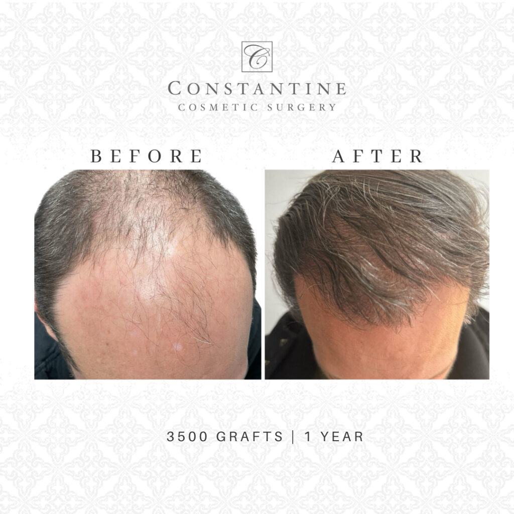 Hair Restoration – Constantine Cosmetic Surgery